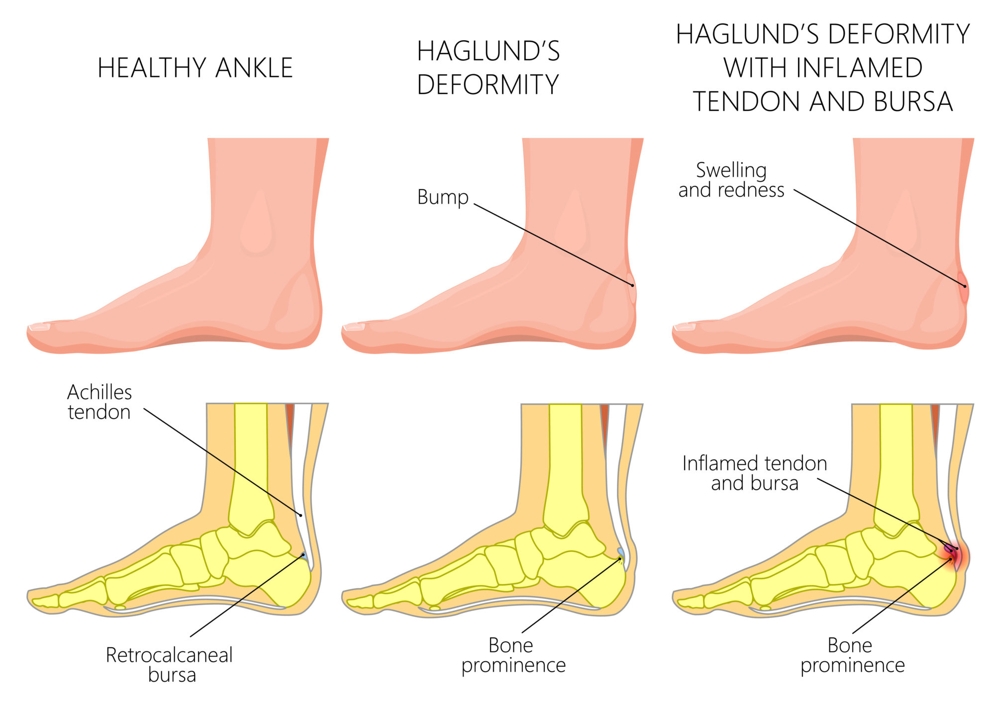 Maladie D Haglund – Haglund Maladie – XVFPIK